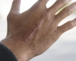 Keloid Treatment, Symptoms, and Causes